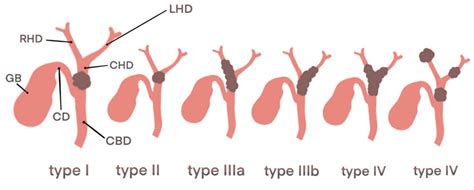 Bismuth Corlette Classification Of Hilar Cholangiocarcinoma Hcca