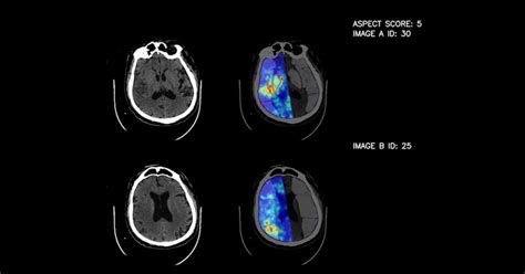 Artificial Intelligence Solution Synapse Helps To Recognize Stroke