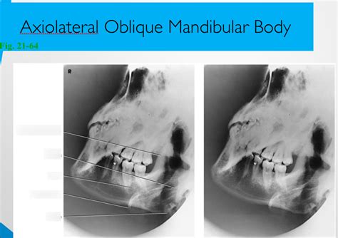 Mandible X Ray Labeled At James Velarde Blog