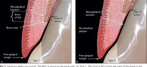 Keratinized Gingiva Histology