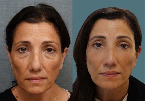Lower Eyelid Blepharoplasty Archives Jeffrey M Joseph
