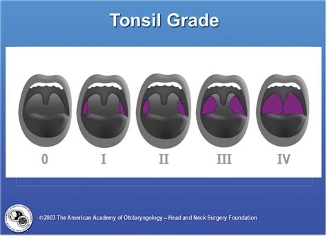 Tonsillectomy After 1 Month