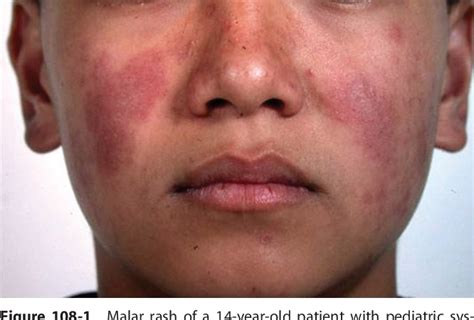 Vasculitis Face