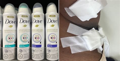 Dove Deodorant Sprays Reportedly Cause Cysts And People Are Freaking