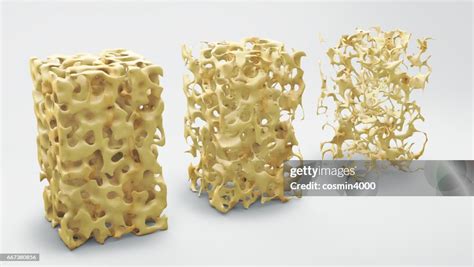 Bone Structure 3d Illustration Normal And With Osteoporosis High Res