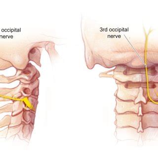 The Course Of The Third Occipital Nerve As It Traverses Over The C2 3