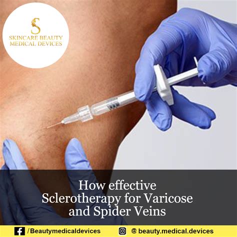 How Effective Sclerotherapy For Varicose And Spider Veins