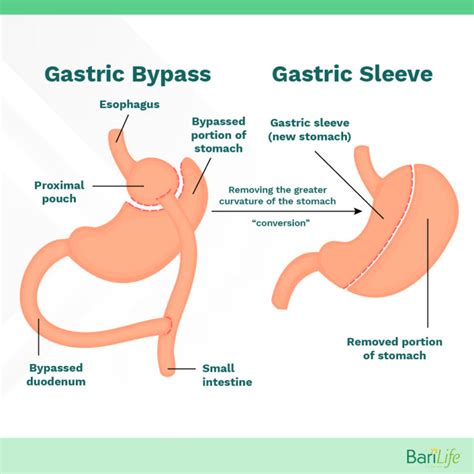 Gastric Sleeve Vs Gastric Bypass Differences Pros Con