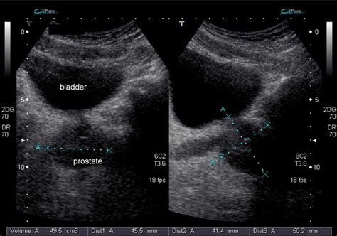 13 best ECOGRAFÍA PROSTÁTICA images on Pinterest Ultrasound Radiology and Anatomy