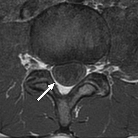 Unilateral Lumbar Spondylolysis On Radiography And Mri Emphasis On Morphologic Differences