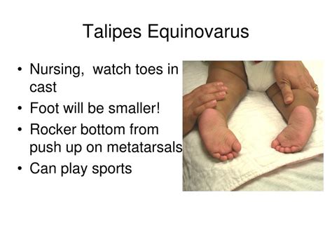 Ppt Pediatric And Neuromuscular Orthopedics Powerpoint Presentation