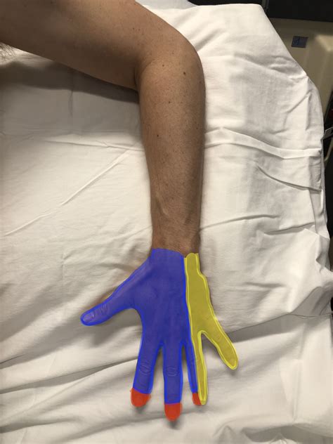 Ulnar Nerve Block Bcpocus