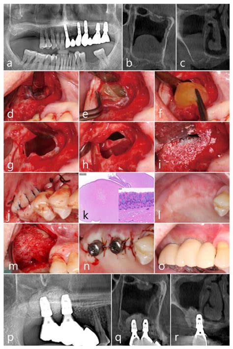 Medicina Free Full Text A Clinical Approach For The Removal Of A Large Antral Pseudocyst