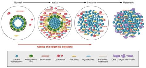 Hypothetical Model Of Breast Tumor Progression Schematic View Of