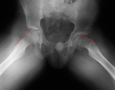 Slipped Capital Femoral Epiphysis