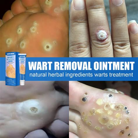 Buy Fast Acting Wart Remover Plantar And Genital Wart Treatment