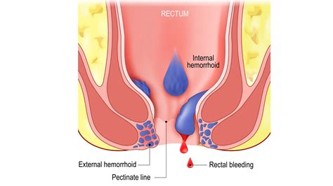 Internal Vs External Hemorrhoids Know The Difference Surgical Care