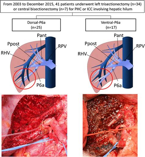 The Pitfalls Of Left Trisectionectomy Or Central Bisectionectomy For