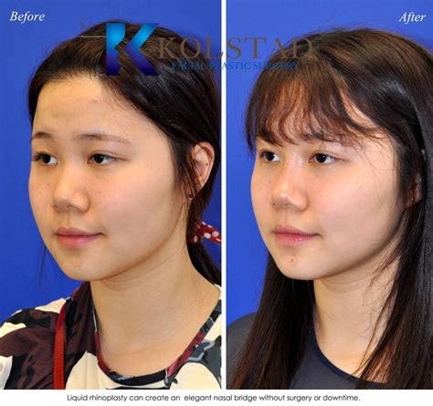 Asian Liquid Filler Rhinoplasty Dr Kolstad San Diego Facial Plastic Surgeon