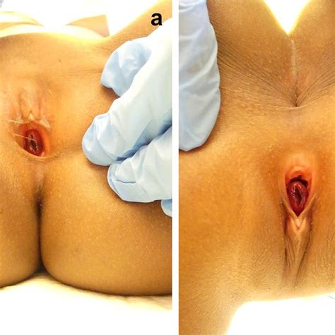 Findings Of The Gynecological Examination In Two Different Positions Download Scientific