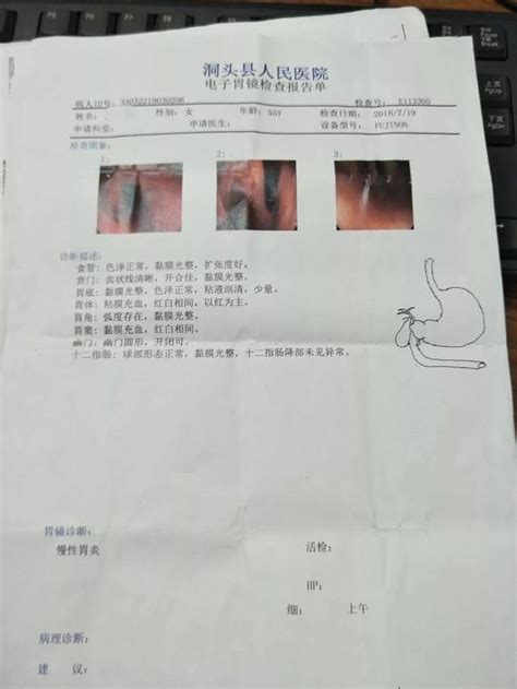 醫案：萎縮性胃炎10餘年伴多種胃部疾病，痊癒了！（馬作峰博士） 每日頭條