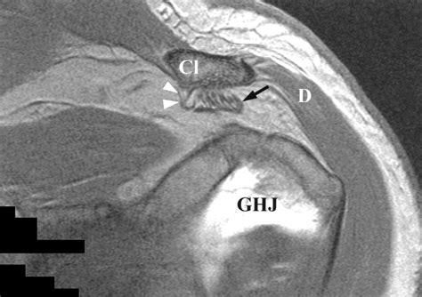 Coracoacromial Ligament Mri