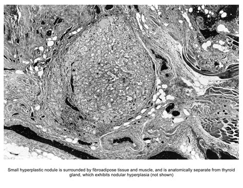 Pathology Outlines Parasitic Nodule