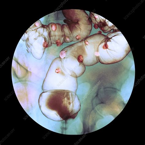 Diverticulitis X Ray Stock Image F008 3455 Science Photo Library