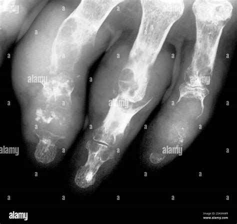 X Ray Of The Fingers Of A Patient With Gout Gout Is A Disorder Of Uric