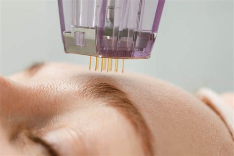 What Is Microneedling Benefits For Skin Rejuvenation And Glow