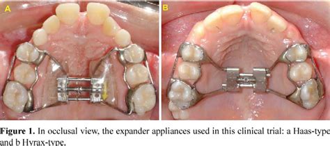 Figure 1 From Immediate Effects Of Rapid Maxillary Expansion On The
