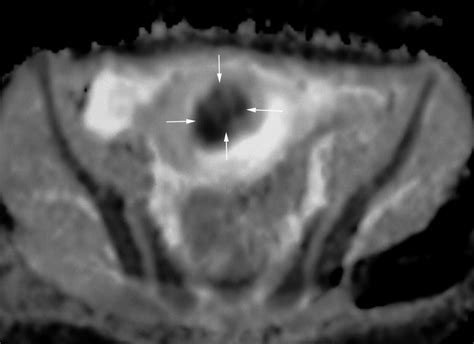 C Dwi Of The Mass Reveals Restricted Diffusion Of The Cycst Content
