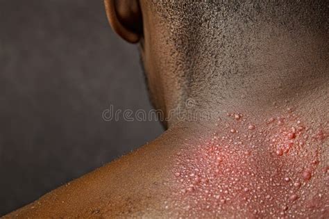 A Man With A Shaved Head And A Red Rash On His Neck Stock Image Image Of Redness Closeup