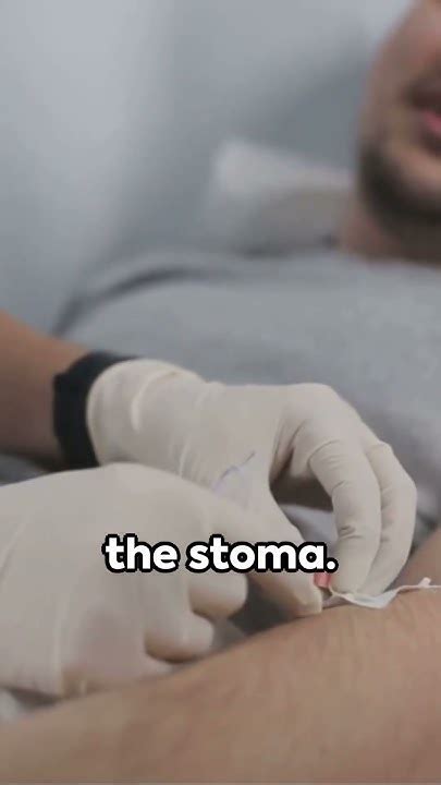 Mastering Suprapubic Catheter Replacement Simplified And Confident