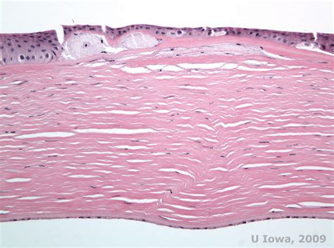 Epithelial Stromal And Stromal Corneal Dystrophies