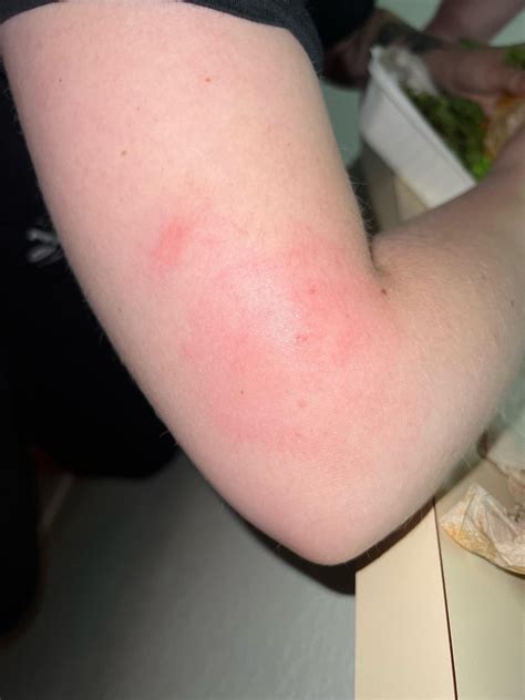 What Kind Of Bug Bites Is This Itchy And Warm Rbugbites