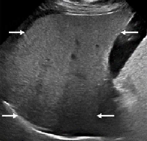 Beam Attenuation In Nafld Diffuse Fatty Deposition In Steatosis Makes Download Scientific