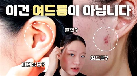 귀뒤 혹 여드름 절대 집에서 짜지 마세요 표피낭종 연고추천 자연치유 관리 예방 Youtube