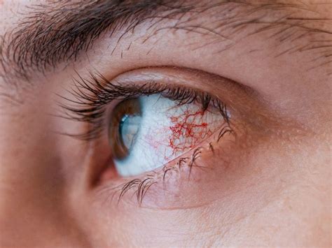 Knowing What Pink Eye Looks Like