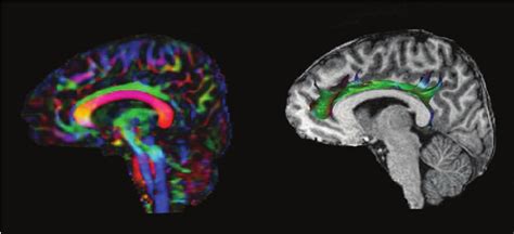 Sagittal Diffusion Tensor Imaging Dti Fractional Anisotropy Fa Download Scientific Diagram
