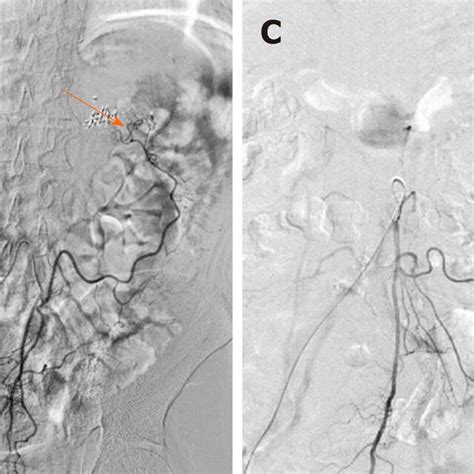 Demonstration Of Lesions In The Inferior Mesenteric Artery And Branches Download Scientific