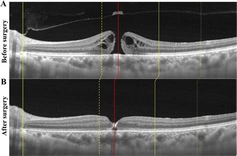Representative Swept Source Optical Coherence Tomography Ss Oct Download Scientific Diagram