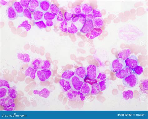 Chronic Myeloid Leukemia Cells Or Cml Stock Image Image Of White Promyeloblast 285451801