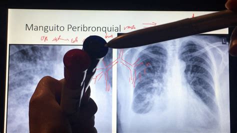 Lección 28 Broncograma Alveolar Y Manguito Peribronquial Radiografía