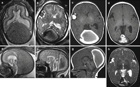 Vascular Malformations Radiology Key