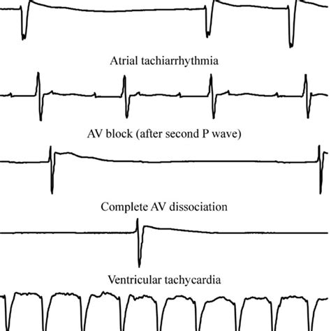 Electrographic Waveform And Interval Durations Electrograms Basic