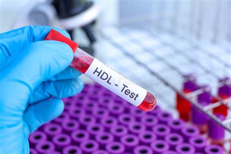 HDL Test To Look For Abnormalities From Blood Stock Image Image Of Hematology Sample