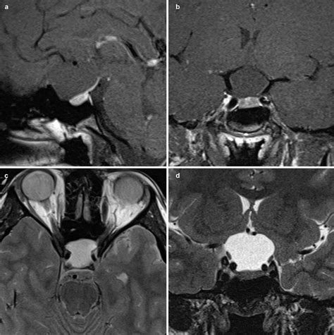 Sellar Region Arachnoid Cysts Neupsy Key