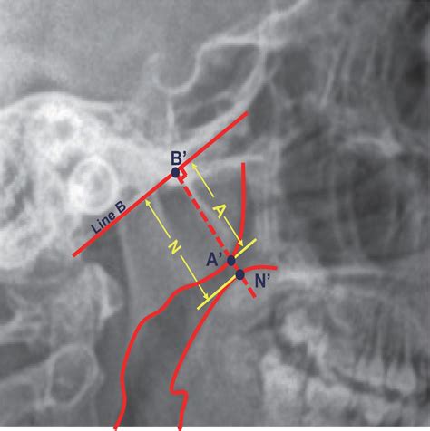 Adenoid Hypertrophy X Ray