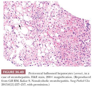 Nonneoplastic Liver Disease Basicmedical Key